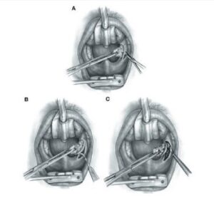 Amigdalectomia - Dra. Taíse Bertazzo